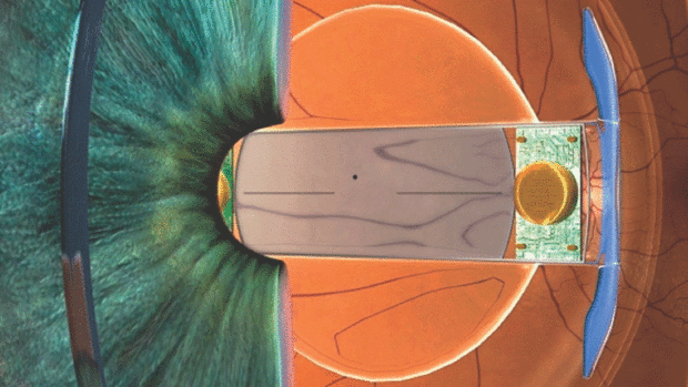AF Intraocular lens: Product Development – Helbling Projects | Helbling