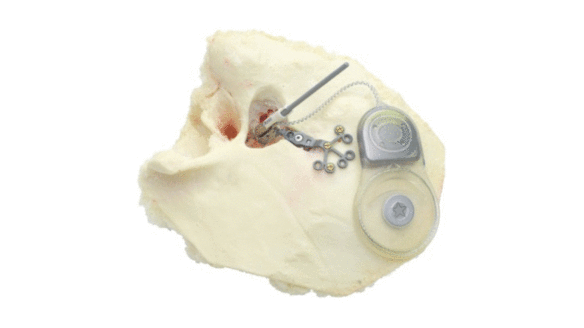 Cochlear Codacs™: Product Development – Helbling Projects | Helbling